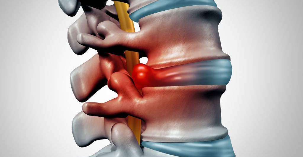 Herniated vs Bulging Disc: Understanding the Key Differences